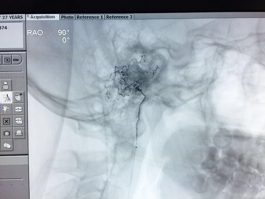 Neuro Vascular dan Endovascular – Neurosurgery